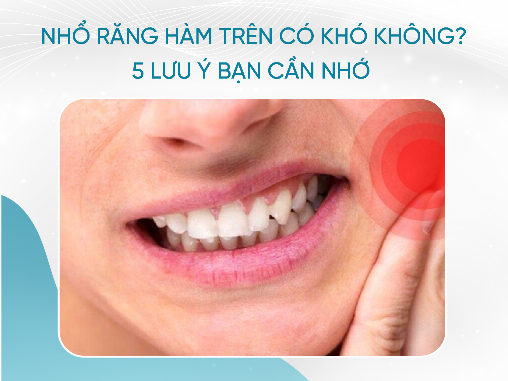 Nhổ răng khôn hàm trên có khó không? 5 lưu ý bạn cần nhớ