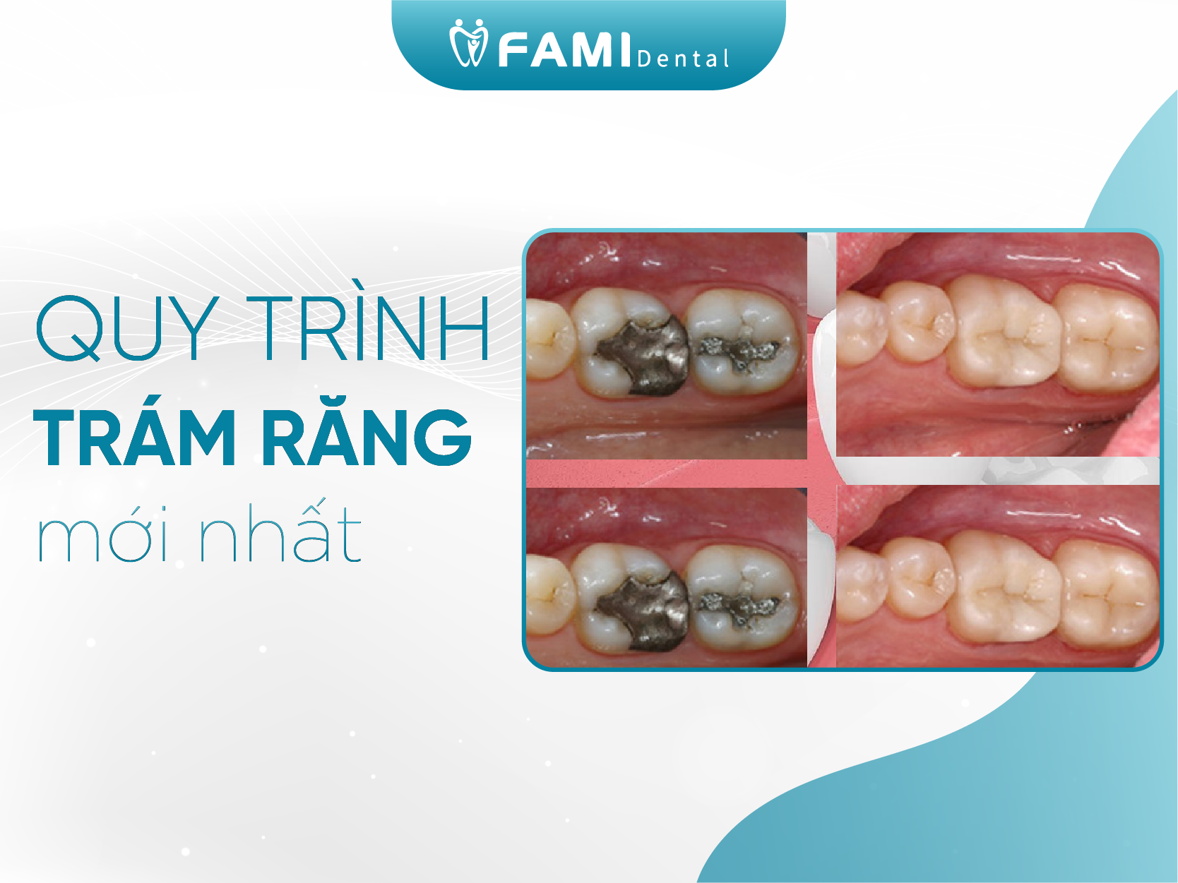 Quy trình trám răng mới nhất 2025 - Nha Khoa Fami 5A Tân Canh
