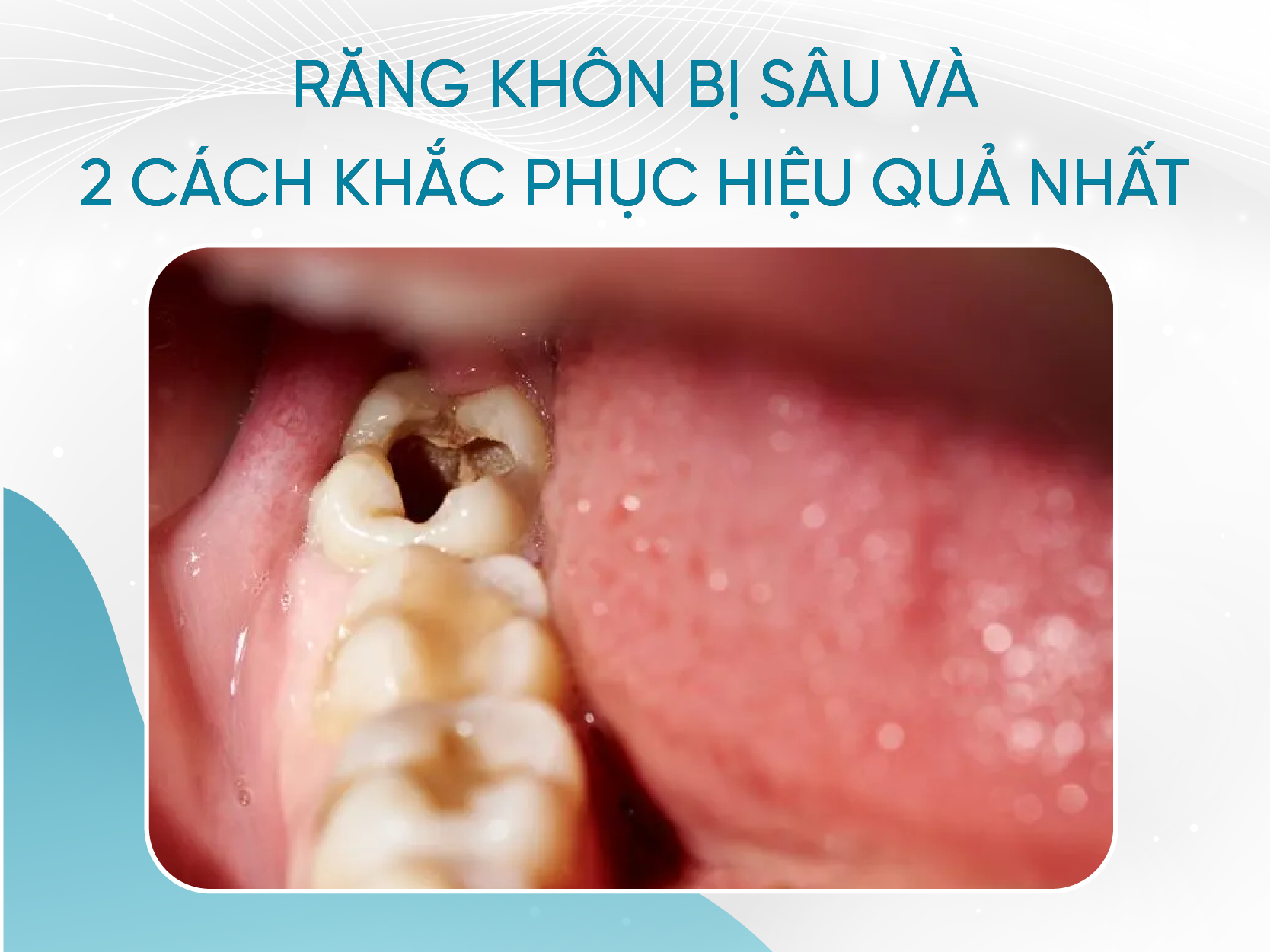 Răng khôn bị sâu và 2 cách điều trị triệt để